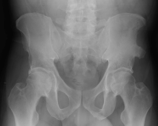 Anterior Superior Iliac Spine (ASIS) Avulsion : 네이버 블로그